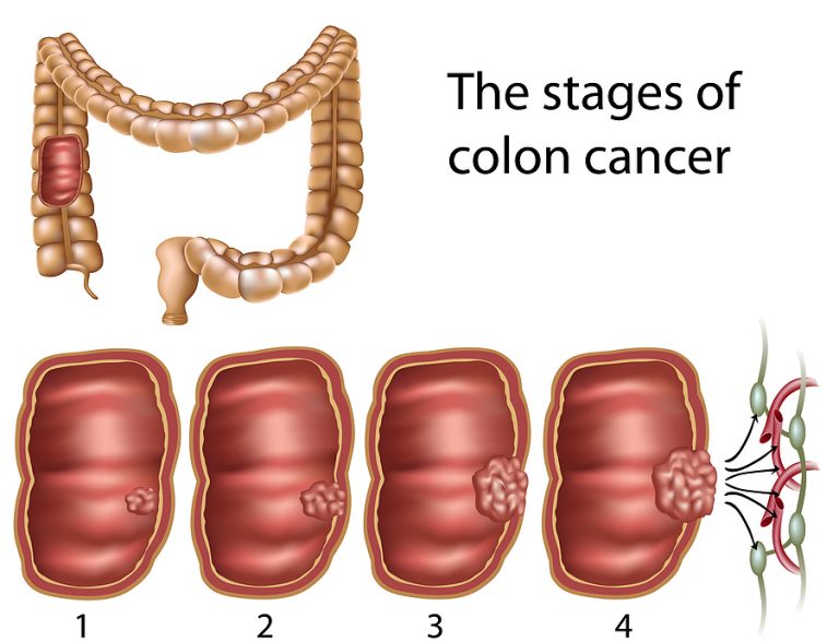 Colon Cancer Surgery | Best Cancer Treatment in Ahmedabad